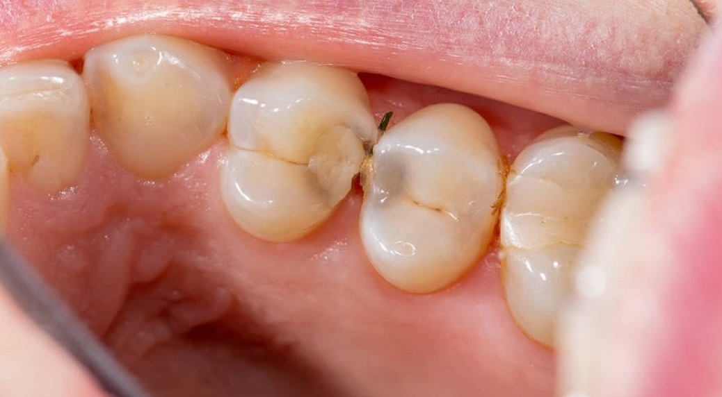 Tooth Decay Under The Crown: Causes and Treatments