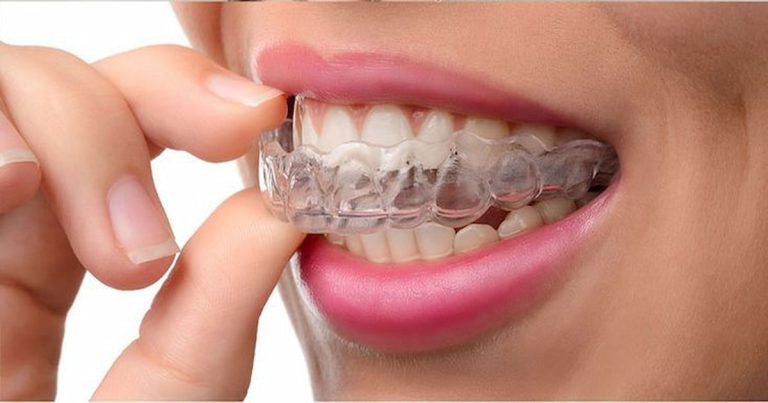 Chewing Gum with Invisalign: Is It Safe?