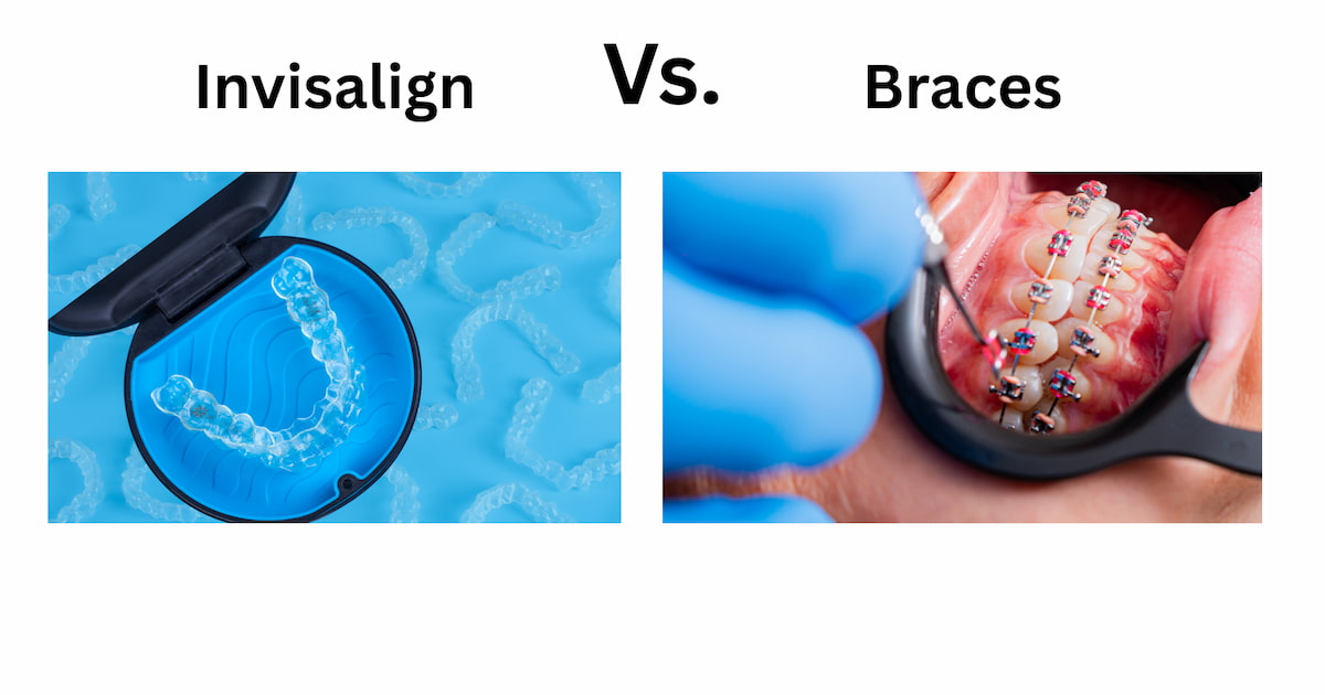 Invisalign vs Braces: What’s the Better Choice for You?