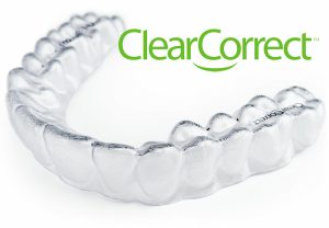 5 Best Invisalign Alternatives: Cost vs. Effectiveness