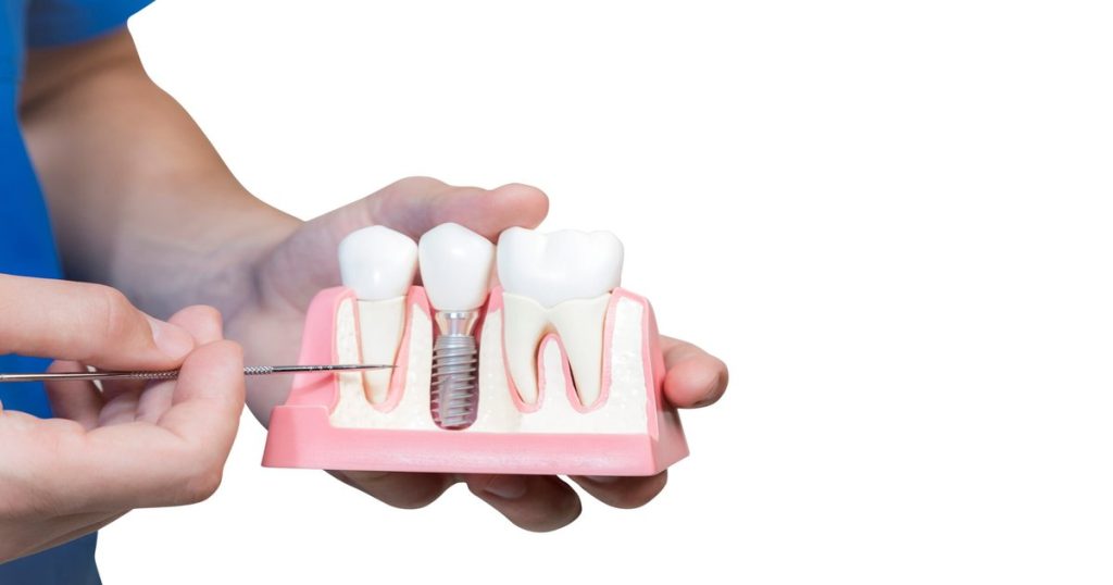 Dental Implant Cost in Canada; 4 Factors Affect the Price