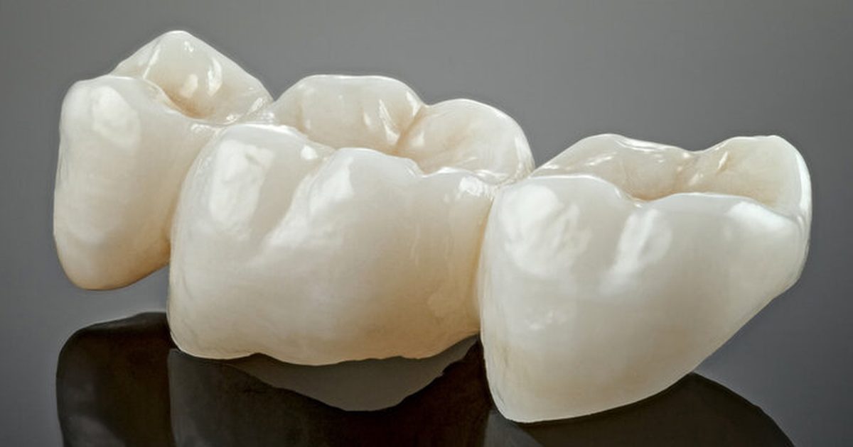 Dental Crowns Lifespan: 5 Factors Affect Crown's Lifespan